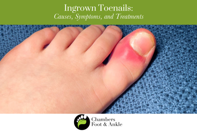 Ingrown Toenails: Causes, Symptoms, and Treatments | Chambers Foot & Ankle